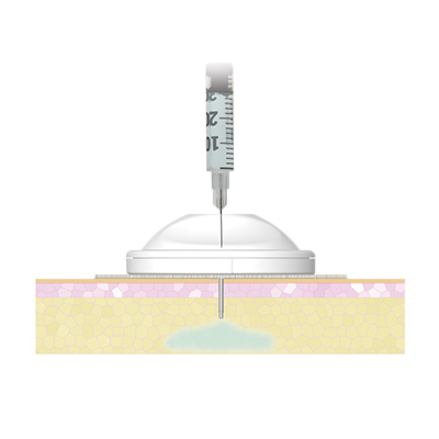 i-Port Advance™ 6mm cannula